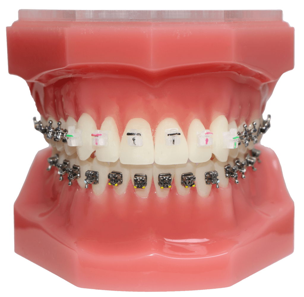 Modern Metal Braces In California | Wow Smiles