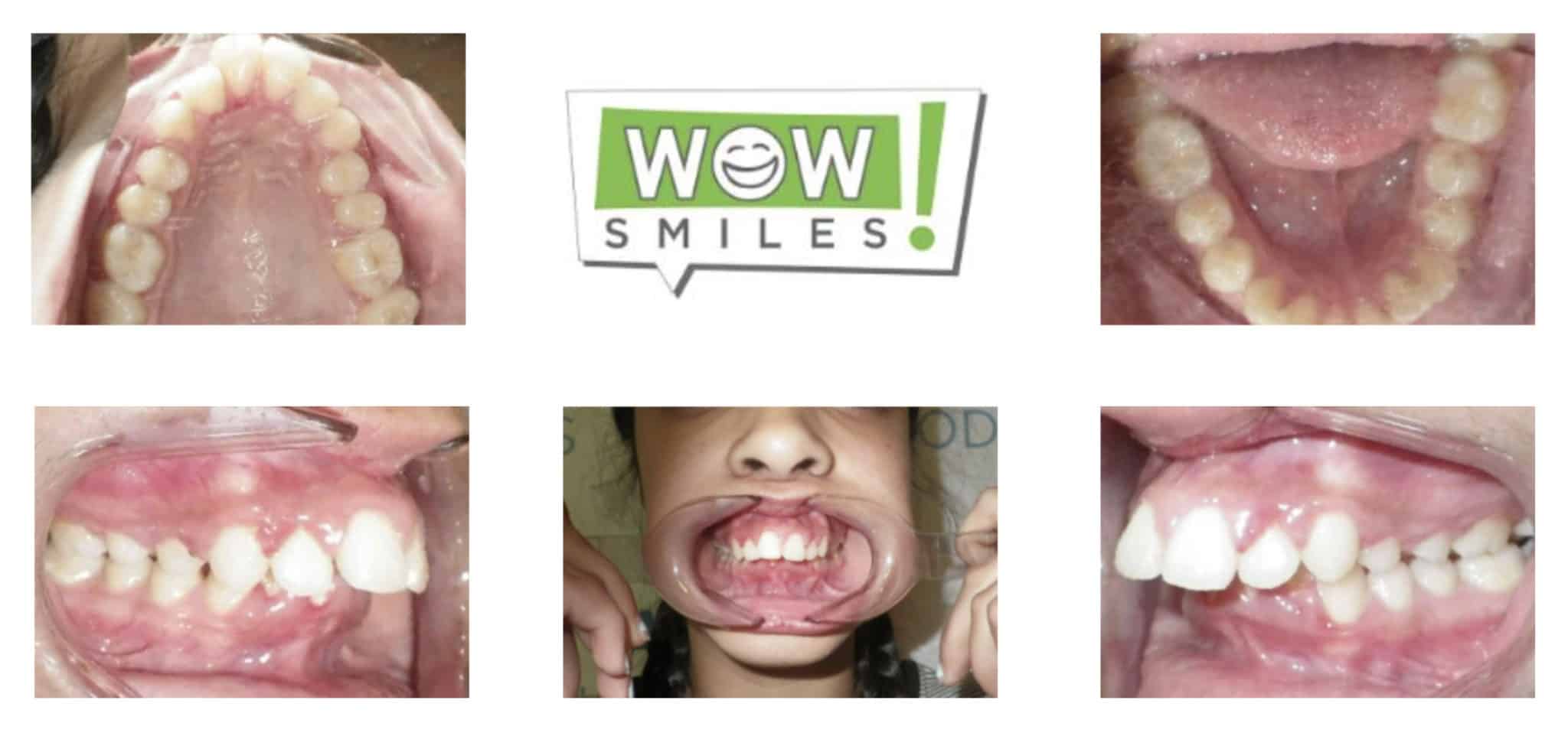 Malocclusion Severity Index - WOW! Smiles