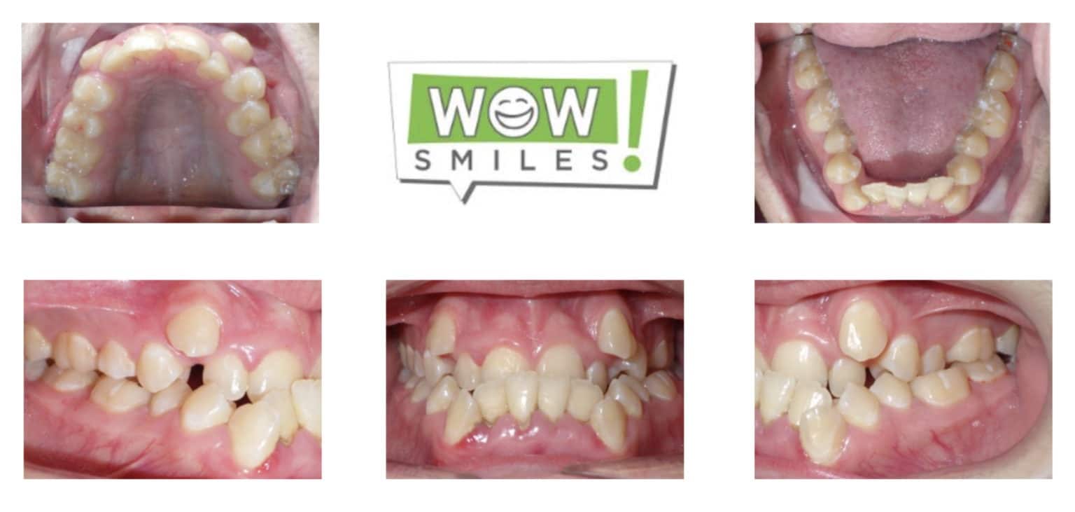 Malocclusion Severity Index - WOW! Smiles